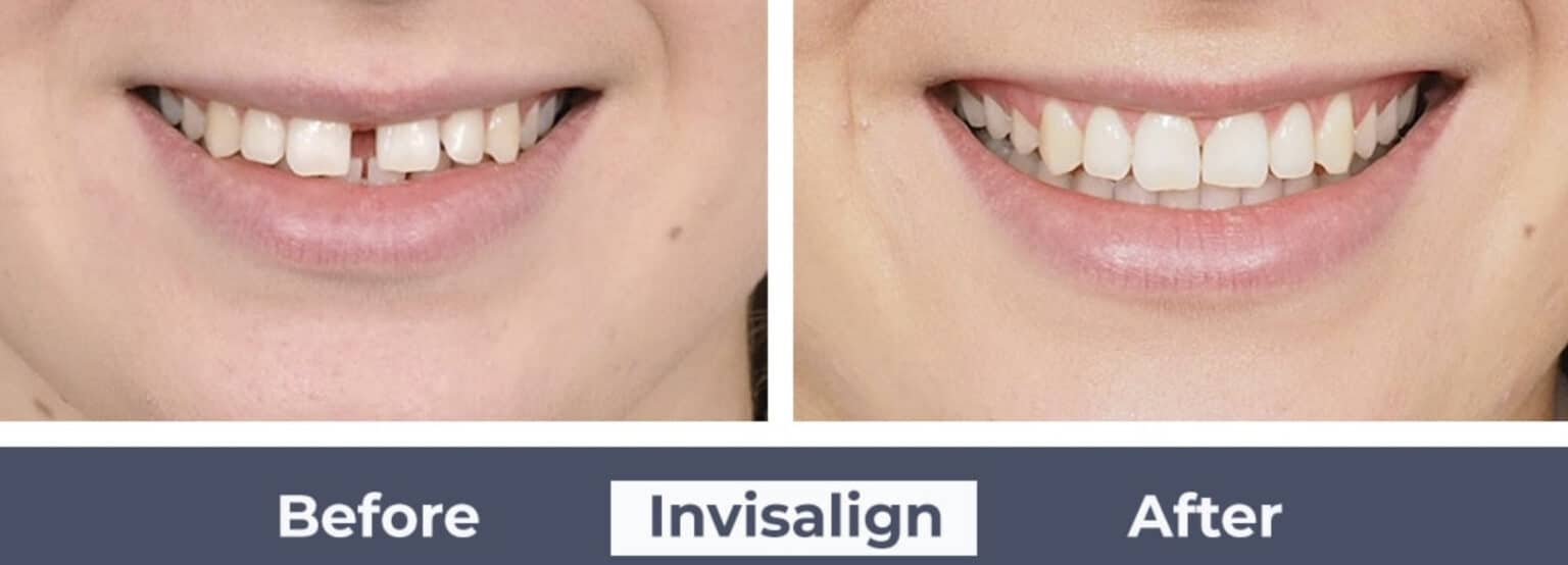 Invisalign® Results