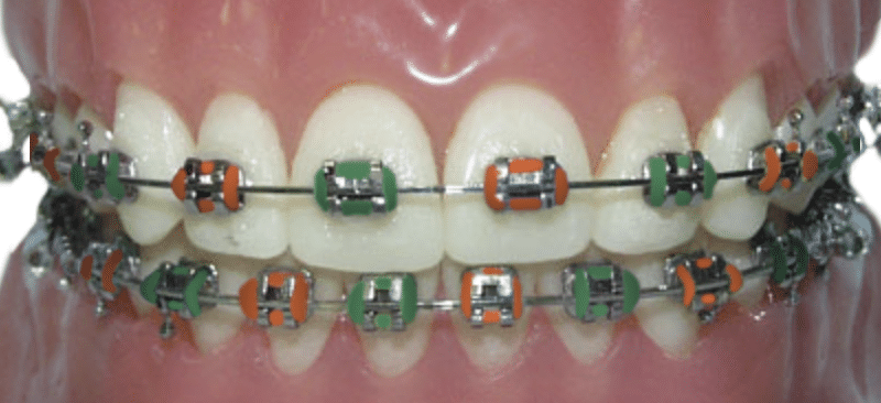 Braces Colours - Try our Colour Picker!