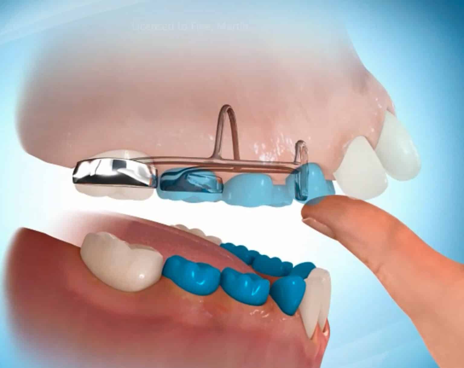 Orthodontic Appliances - Fine Orthodontist Sydney