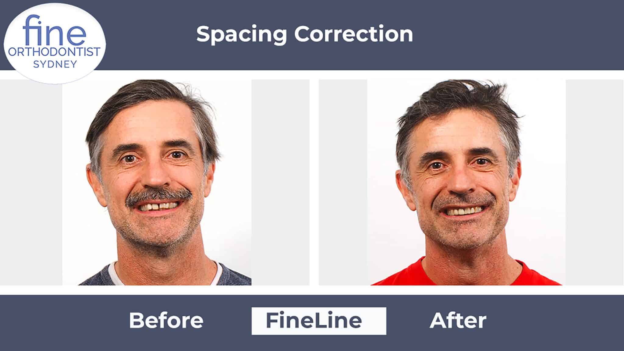 FineLine Clear Aligners - Fine Orthodontist Sydney